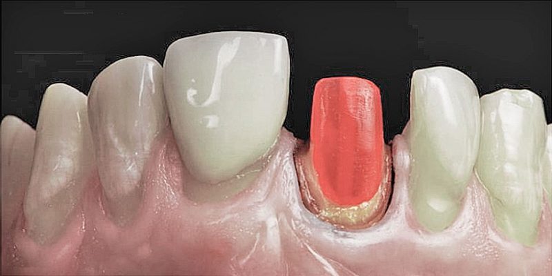 Reconstruction of Endodontically Treated Teeth - DENTAL VIP Posts