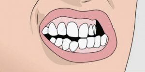 Signs and Symptoms of Masticatory Dysfunction or “Bad Bite” - DENTAL ...