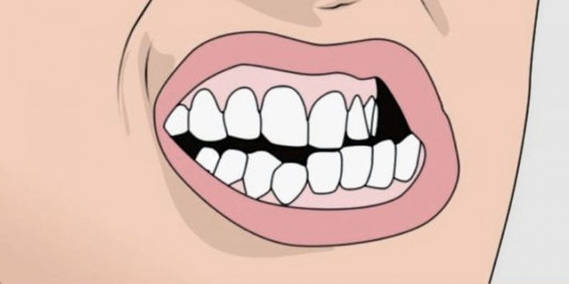 Signs and Symptoms of Masticatory Dysfunction or “Bad Bite” - DENTAL ...