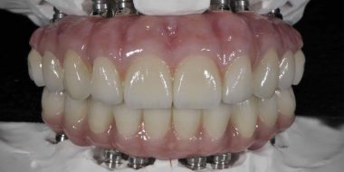 The Hybrid Prosthesis As Implant Restorative Solution - DENTAL VIP Posts