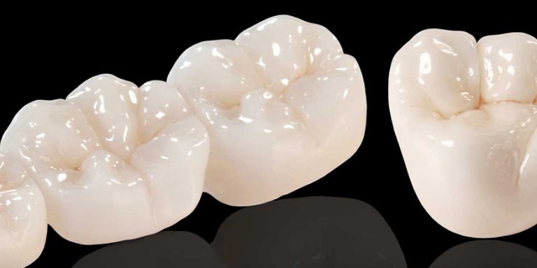 Choosing the Right Structure for Crowns and Bridges… - DENTAL VIP Posts