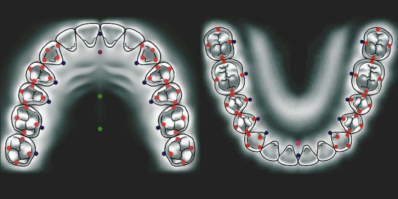Occlusal Equilibration by Selective Grinding - DENTAL VIP Posts
