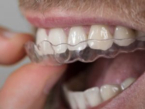 Occlusal Equilibration by Selective Grinding - DENTAL VIP Posts