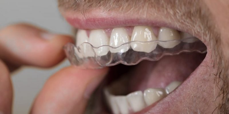 Types of Bite Splints to Protect Your Teeth - DENTAL VIP Posts